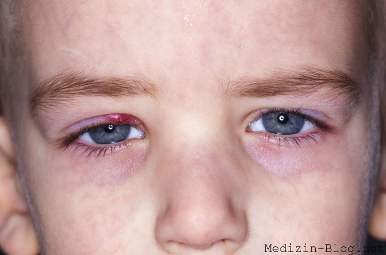 Gerstenkorn – eine eitrige Entzündung am Augenlid - Medizin-Blog.net