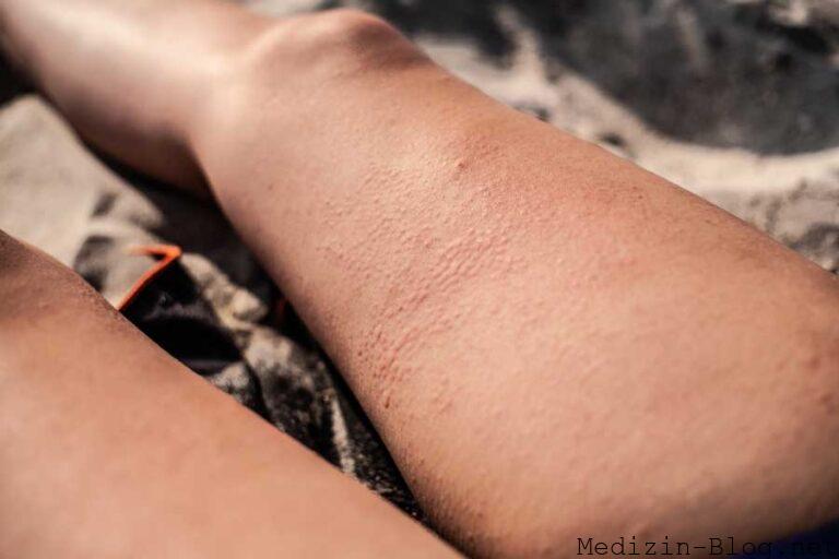 Hitzepickel: Ursachen und Behandlung im Überblick