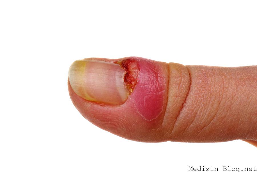 Nagelbett entzündet – Tipps zur effektiven Behandlung