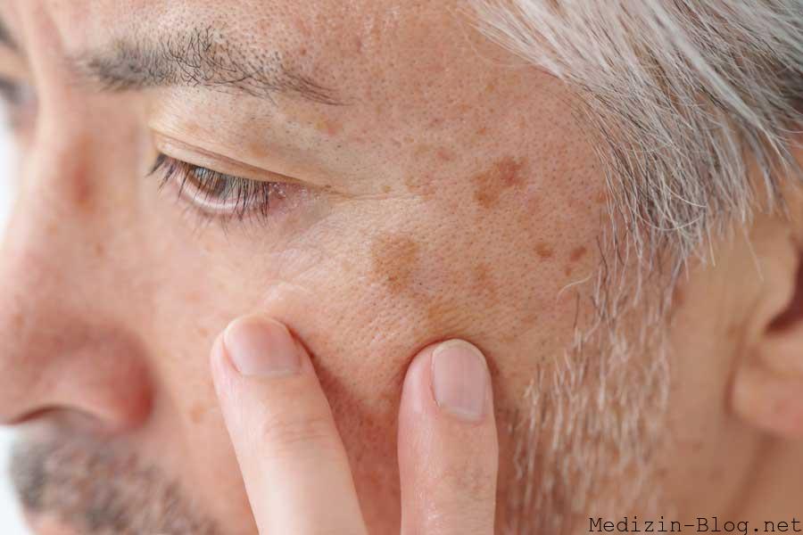 Altersflecken entfernen – Effektive Methoden